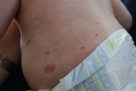 Microcephaly Capillary Malformation Syndrome Symptoms Nargilb