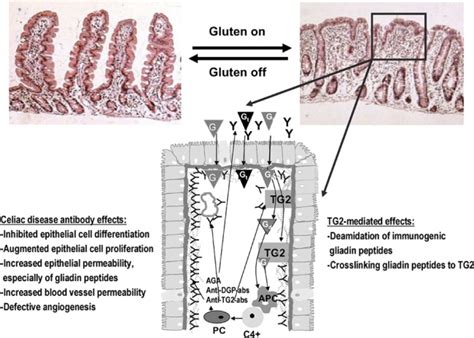 Antibodies In Celiac Disease Implications Beyond Diagnostics Pmc