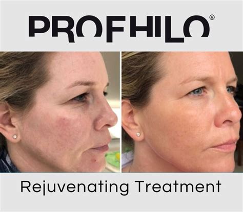Profhilo Treatment Serenity Clinic Malta