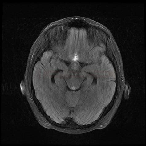 Vasculitis Stroke Manual