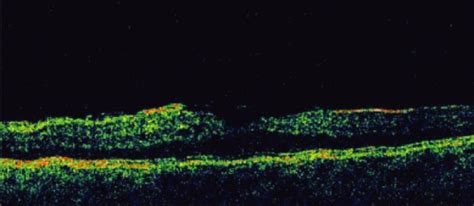 Intermediate Uveitis Ento Key