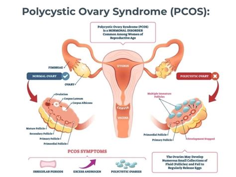 Polycystic Ovary Syndrome Pcos The Health Suite Leicester