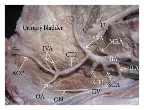 Superior View Of The Left Hemipelvis Aop Artery Of Penis Ct1