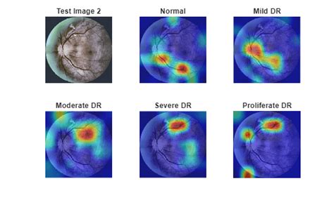 Multilabel Diabetic Retinopathy Fundus Image Classification Using Deep