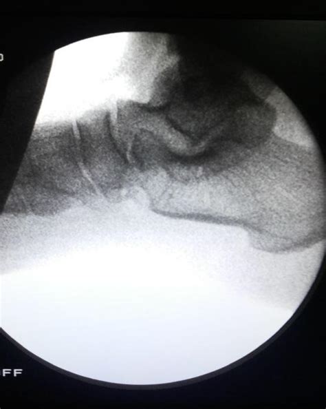 Posterior Dislocation Of The Subtalar Joint A Case Report The Foot And Ankle Online Journal