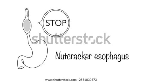 Nutcracker Esophagus Over 22 Royalty Free Licensable Stock