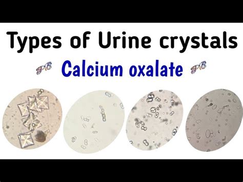 Types Of Crystals In Urine Most Common Types Of Crystals Appear Under