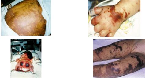 Lecture 11 Hypercoagulable States Flashcards Quizlet