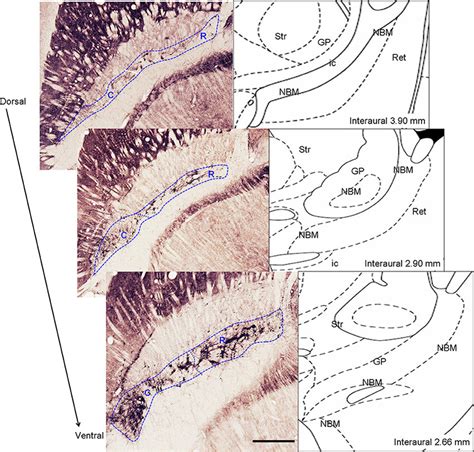 Left Anatomic Delimitation Of Magnocellular Basal Nucleus Mbn And