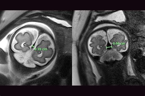 Could The Falcine Sinus Hold The Key To Vein Of Galen Outcomes