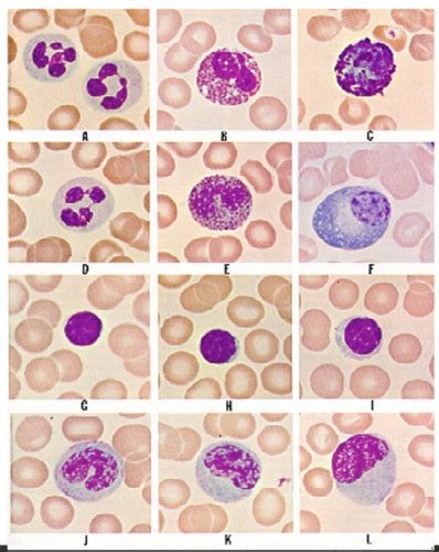Diseases Of Wbc And Lymph Nodes Flashcards Quizlet
