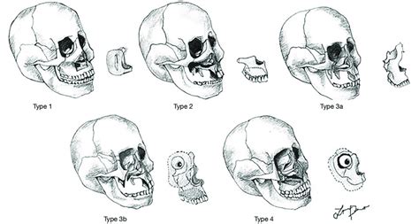 Classification System For Maxillectomy And Midfacial Defects With