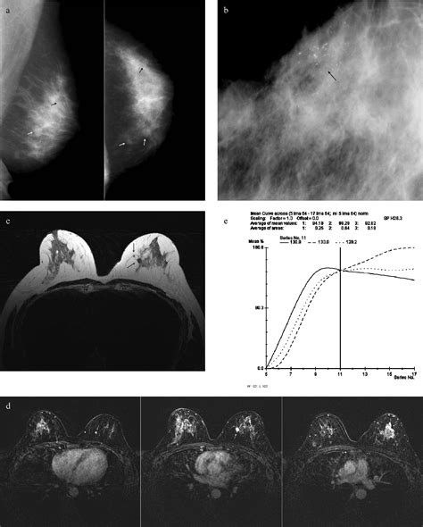 Figure 1 From The Value Of Dynamic Contrast Enhanced Breast Mri In