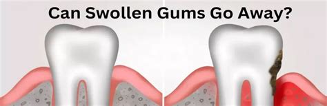 Gum Swelling Treatment Istanbul Causes And Solutions