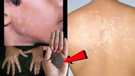 ചുണങ്ങ് മാറുവാനുള്ള ഒറ്റമൂലികൾ Home Remedies For Scurf