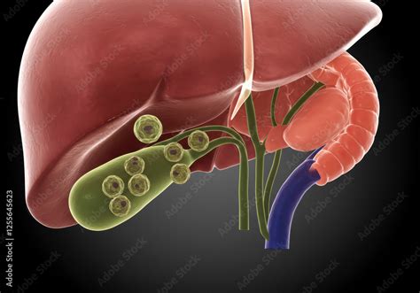Gallstone Disease In 3d Visualizing Gallbladder Calculi And Their