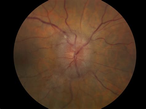 How To Grade Papilledema