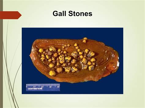 Cholycystitis Inflammation Of Gall Bladder Pptx