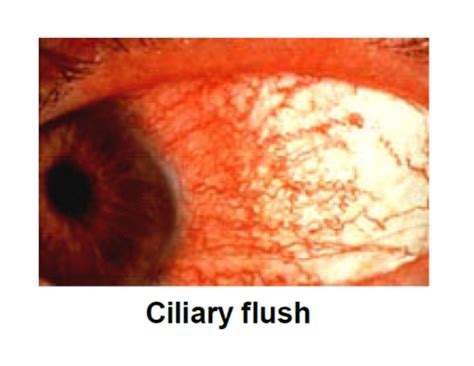Ciliary Flush Vs Conjunctivitis