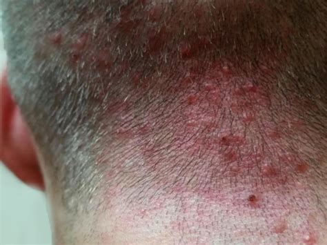 Folliculitis Genital
