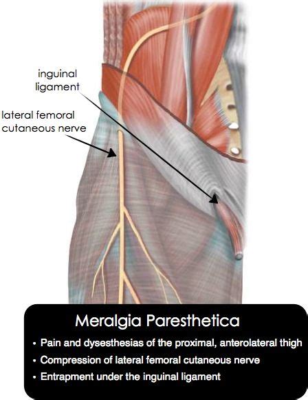 Meralgia Paresthetica