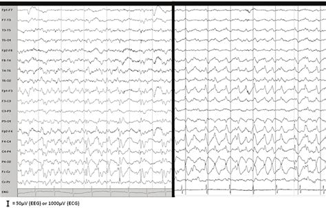 Interictal Eeg Before Vertical Black Line Spikes With Phase Reversal Download Scientific