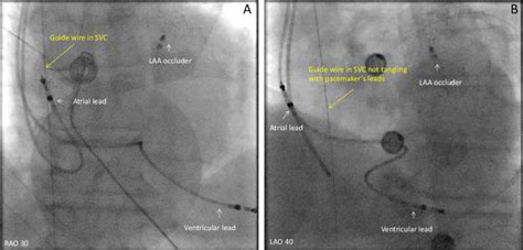 Baseline Fluoroscopic Position Of The Cardiac Device Download