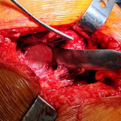 Appearance Of The Acetabulum Following Reaming Download Scientific