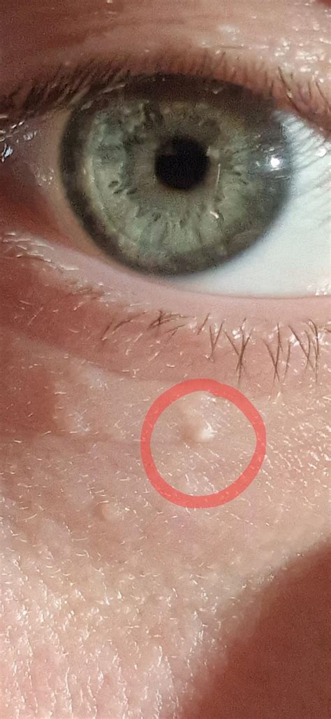 White Bumps Under Eye Rdermatologyquestions
