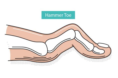 Hammer Toe Causes Diagnosis And Treatment The Foot Hub