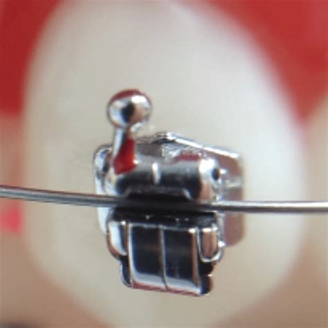 Smart Line® Passive Self Ligating Brackets Individuals