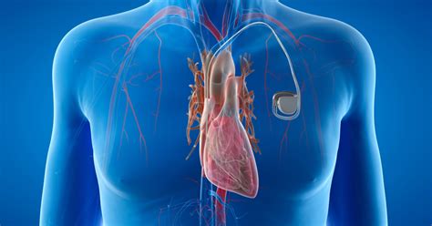 A Navigation System To Guide Placement Of Cardiac Pacemaker Leads