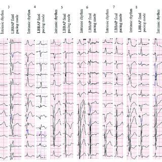 One Beat Of Intrinsic Rhythm With Left Bundle Branch Block Lbbb And 1