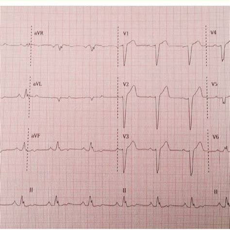 2d Echocardiogram Showing The Noncompaction Over Compaction Myocardial