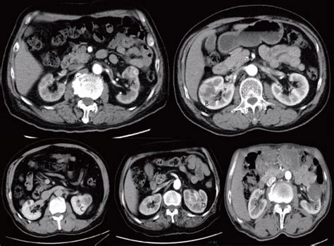 development and validation of ct imaging based preoperative nomo cmar