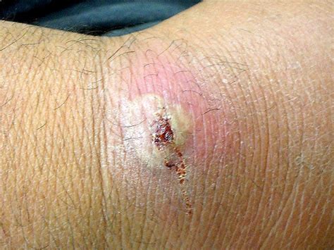 Bug Bite Vs Staph Infection