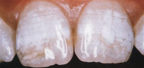 Understanding Fluoride Treatment A Guide For Patients Web Dmd