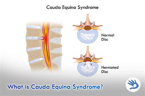 Cauda Equina Syndrome Ces Is A Physiotherapy At Home
