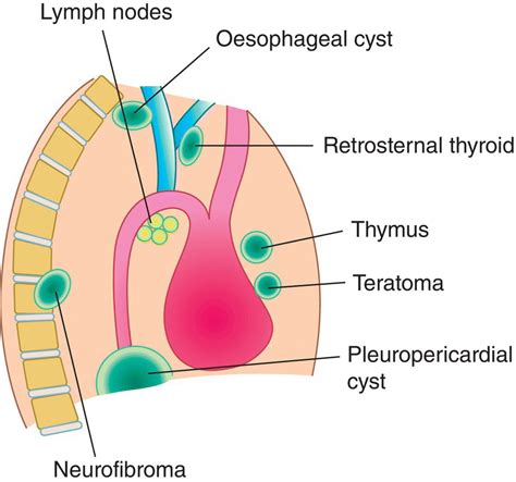 16 Disorders Of The Mediastinum Thoracic Key