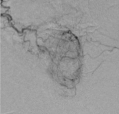 Contrast Enhancement At The Level Of Right Prostatic Lobe With The