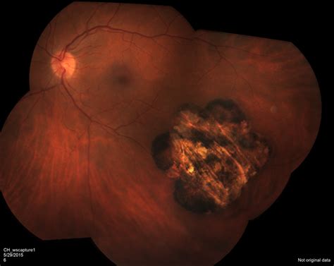 Chorioretinal Scar Retina Image Bank
