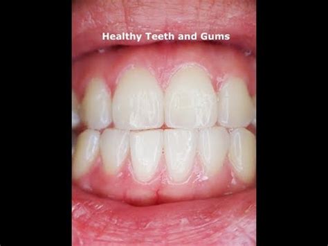 Healthy Teeth And Gums Youtube
