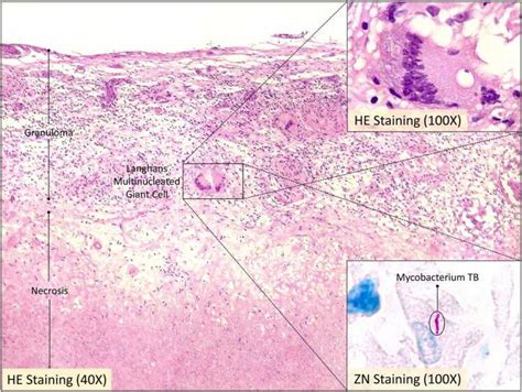 Intracranial Tuberculoma Masquerading As A Brain Tumor A Rare