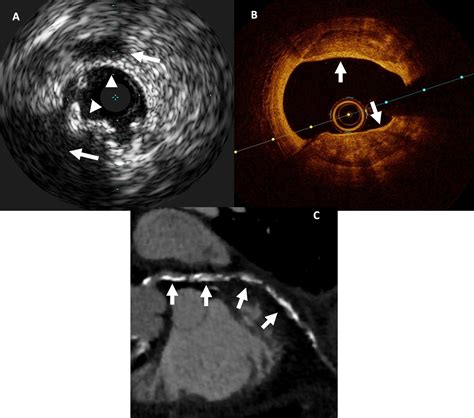 Coronary Artery Calcification Current Concepts And Clinical