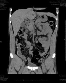 Acute Appendicitis Associated With Ct Intraluminal Hyperattenuation