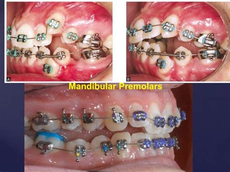 Placement Of Orthodontic Brackets Pptx Dental Health Diseases And