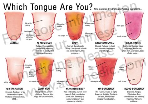 What Does A Deviated Tongue Mean At Maria Brim Blog