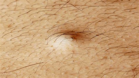 Pubic Cyst