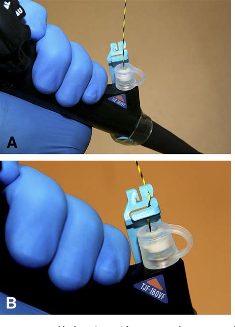 Figure 1 From Short Wire Ercp Systems Semantic Scholar