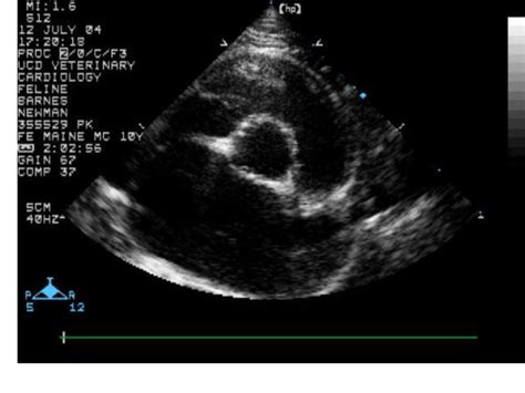 Echo Mitral Stenosis Pptx Heart And Cardiovascular Diseases Diseases And Conditions